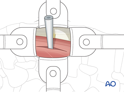 Minimally invasive transpsoas approach (L2–L4)