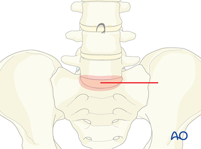 Retroperitoneal approach for Anterior lumbar interbody fusion (ALIF)