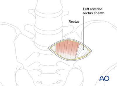 Retroperitoneal approach for Anterior lumbar interbody fusion (ALIF)