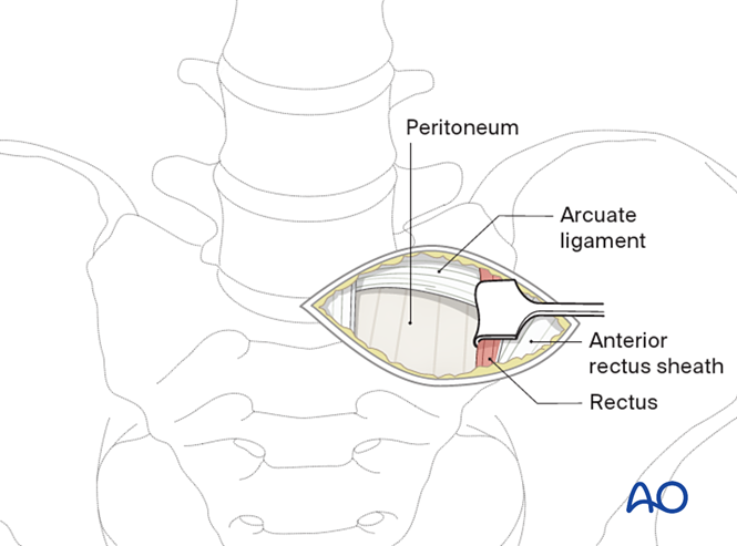 Retroperitoneal approach for Anterior lumbar interbody fusion (ALIF)