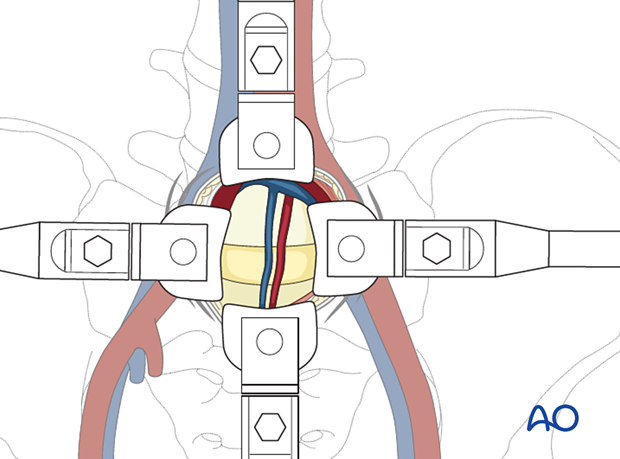 Retroperitoneal Approach For Anterior Lumbar Interbody Fusion Alif