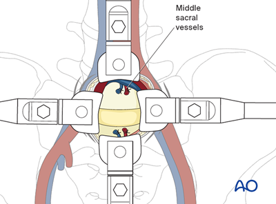Retroperitoneal approach for Anterior lumbar interbody fusion (ALIF)