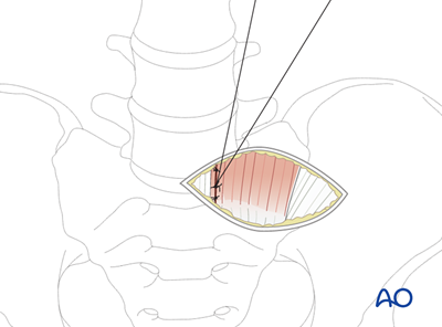 Retroperitoneal approach for Anterior lumbar interbody fusion (ALIF)