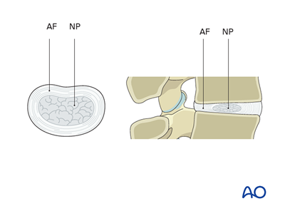 Lumbar disc herniation – foraminal and extraforaminal