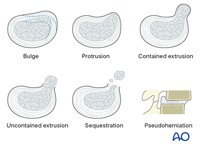 Lumbar disc herniation – central and posterolateral