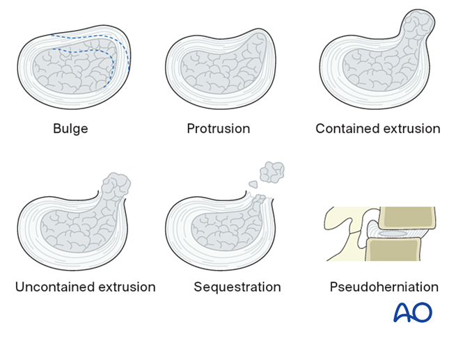 Lumbar disc herniation – foraminal and extraforaminal