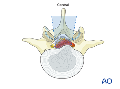 Lumbar disc herniation – central and posterolateral