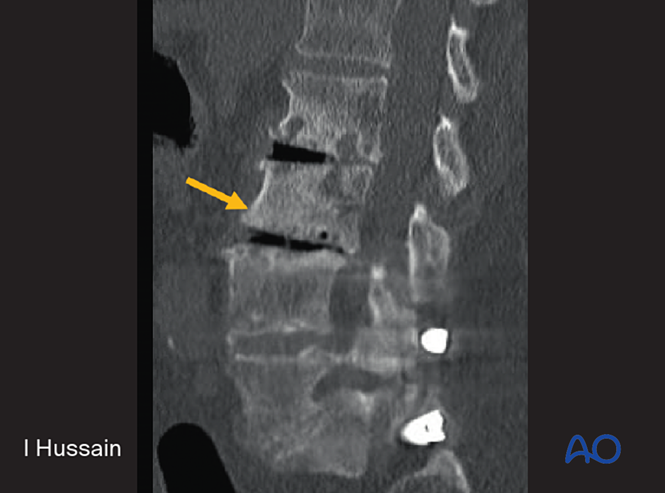 Degenerative spondylolisthesis