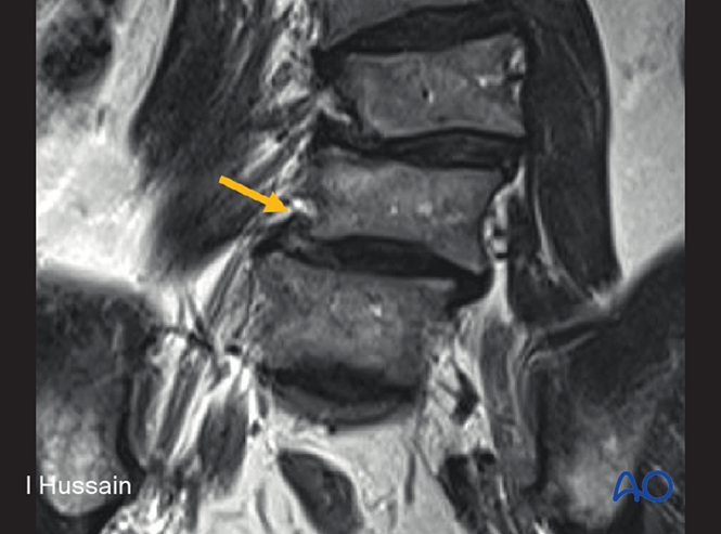 Degenerative spondylolisthesis
