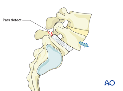 Degenerative spondylolisthesis