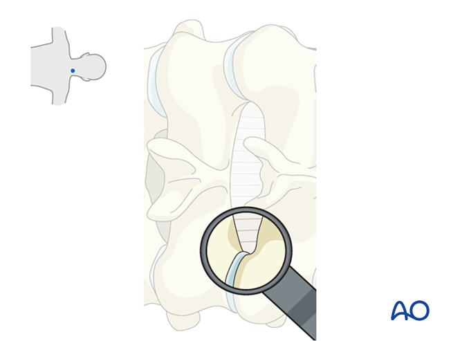 Posterior microscopic tubular cervical foraminotomy (PMTCF) for ...
