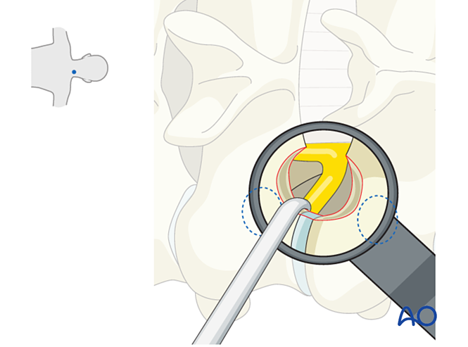Posterior microscopic tubular cervical foraminotomy (PMTCF) for ...