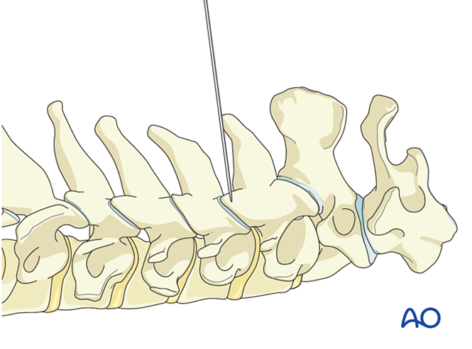 Posterior microscopic tubular cervical foraminotomy (PMTCF) for ...