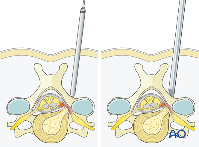 Posterior endoscopic cervical foraminotomy (PECF) for Cervical disc ...
