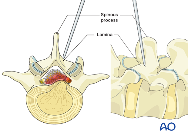 Interlaminar Microscopic Tubular Lumbar Discectomy Imtld For Lumbar