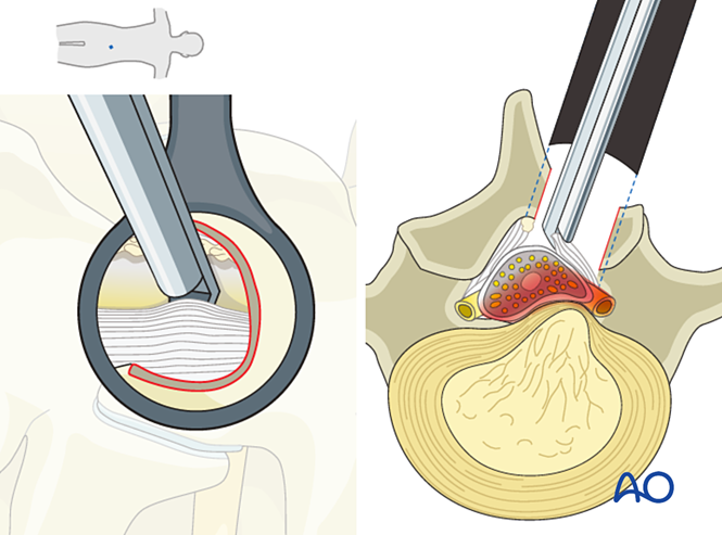 Interlaminar microscopic tubular lumbar discectomy (IMTLD) for Lumbar ...