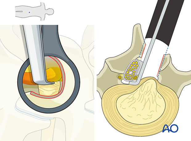 Interlaminar Microscopic Tubular Lumbar Discectomy Imtld For Lumbar
