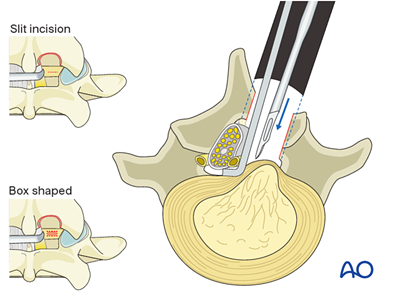 Interlaminar microscopic tubular lumbar discectomy (IMTLD) for Lumbar ...