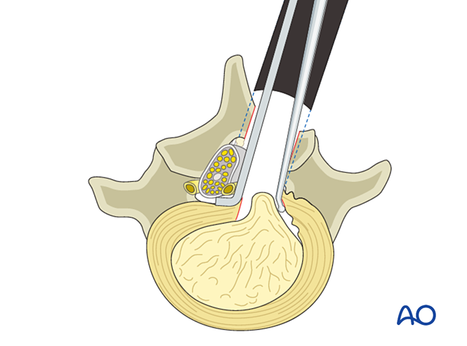 Interlaminar microscopic tubular lumbar discectomy (IMTLD) for Lumbar ...