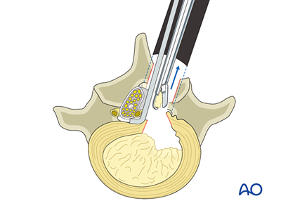 Interlaminar microscopic tubular lumbar discectomy (IMTLD) for Lumbar ...