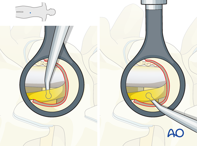 Interlaminar microscopic tubular lumbar discectomy (IMTLD) for Lumbar ...