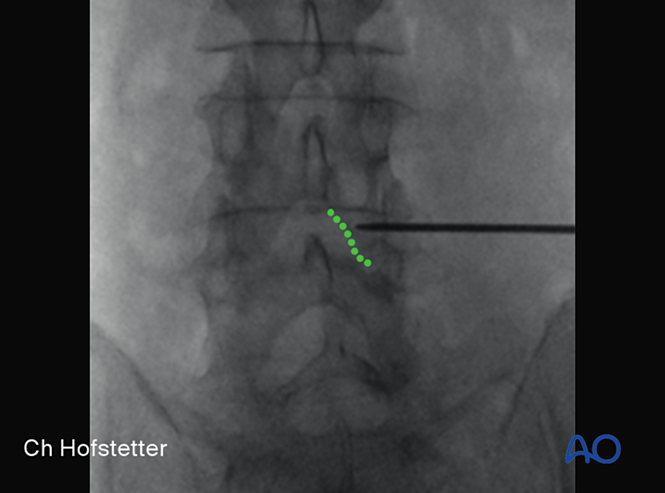 Interlaminar endoscopic lumbar discectomy (IELD) for Lumbar disc ...