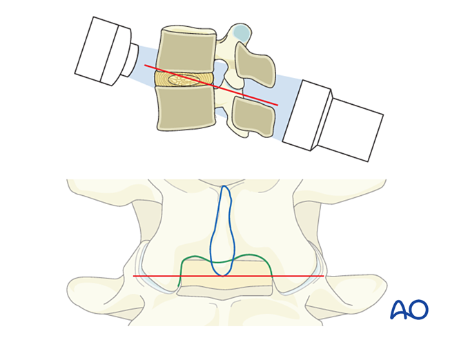 Lumbar endoscopic unilateral laminotomy for bilateral decompression (LE ...