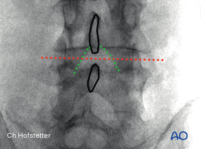 Lumbar endoscopic unilateral laminotomy for bilateral decompression (LE ...
