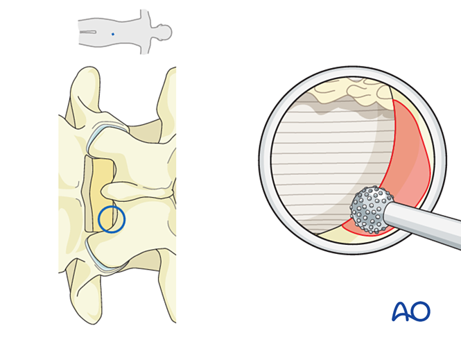 Interlaminar endoscopic lumbar discectomy (IELD) for Lumbar disc ...