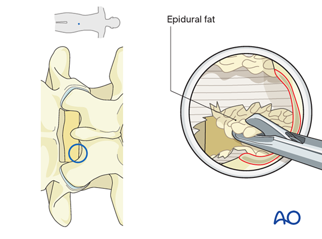 Interlaminar endoscopic lumbar discectomy (IELD) for Lumbar disc ...