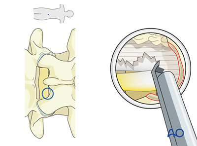 Interlaminar endoscopic lumbar discectomy (IELD) for Lumbar disc ...