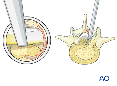 Interlaminar endoscopic lumbar discectomy (IELD) for Lumbar disc ...