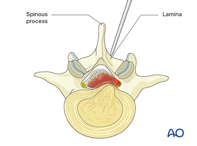 Interlaminar endoscopic lumbar discectomy (IELD) for Lumbar disc ...