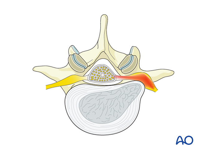 Extraforaminal Endoscopic Lumbar Discectomy Eeld For Lumbar Disc Herniation Foraminal And