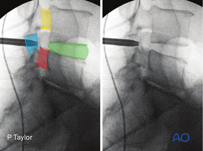 Extraforaminal microscopic tubular lumbar discectomy (EMTLD) for Lumbar ...