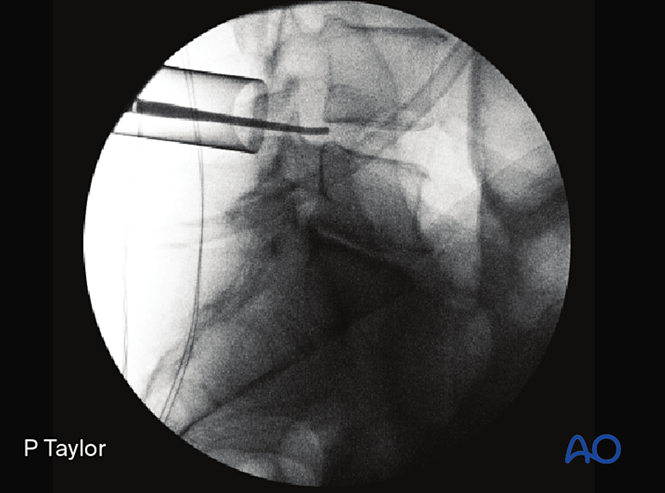 Extraforaminal microscopic tubular lumbar discectomy (EMTLD) for Lumbar ...