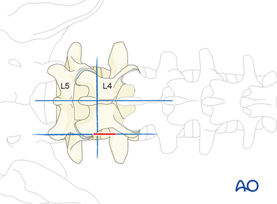Extraforaminal microscopic tubular lumbar discectomy (EMTLD) for Lumbar ...