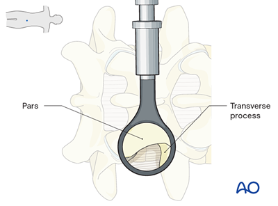 Extraforaminal microscopic tubular lumbar discectomy (EMTLD) for Lumbar ...
