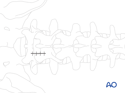 Extraforaminal microscopic tubular lumbar discectomy (EMTLD) for Lumbar ...