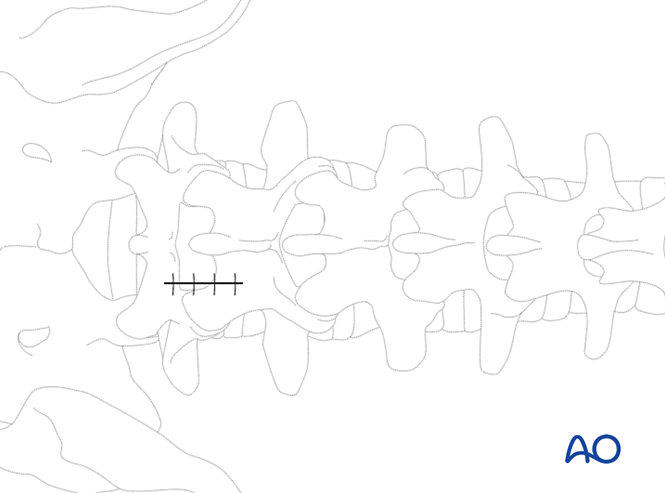 Extraforaminal microscopic tubular lumbar discectomy (EMTLD) for Lumbar ...