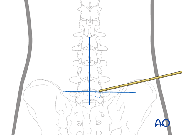 Extraforaminal Endoscopic Lumbar Discectomy Eeld For Lumbar Disc Herniation Foraminal And