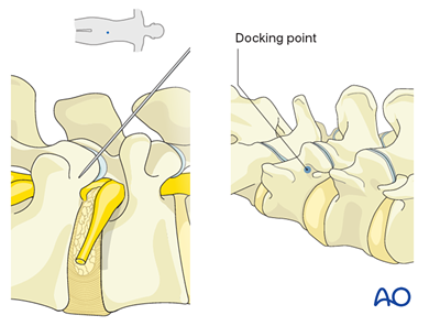Extraforaminal endoscopic lumbar discectomy (EELD) for Lumbar disc ...