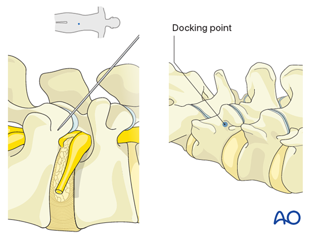 Extraforaminal endoscopic lumbar discectomy (EELD) for Lumbar disc ...