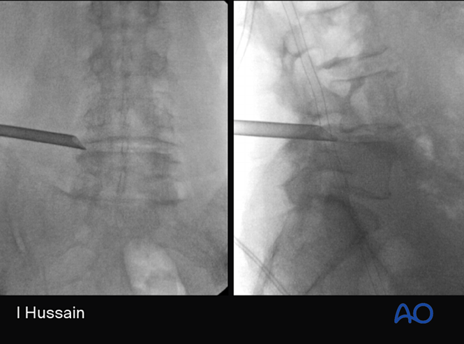 Extraforaminal Endoscopic Lumbar Discectomy Eeld For Lumbar Disc Herniation Foraminal And