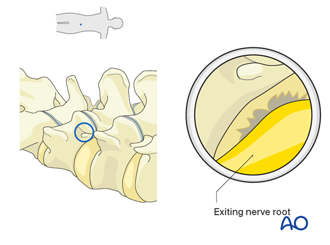 Extraforaminal endoscopic lumbar discectomy (EELD) for Lumbar disc ...