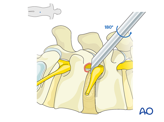 Extraforaminal endoscopic lumbar discectomy (EELD) for Lumbar disc ...