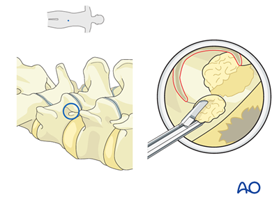 Extraforaminal endoscopic lumbar discectomy (EELD) for Lumbar disc ...