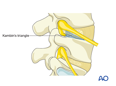Transforaminal endoscopic lumbar discectomy (TELD) for Lumbar disc ...