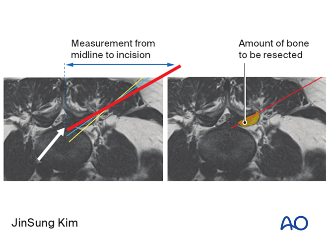 Transforaminal endoscopic lumbar discectomy (TELD) for Lumbar disc ...