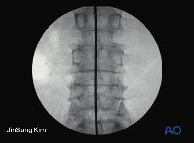 Extraforaminal endoscopic lumbar discectomy (EELD) for Lumbar disc ...